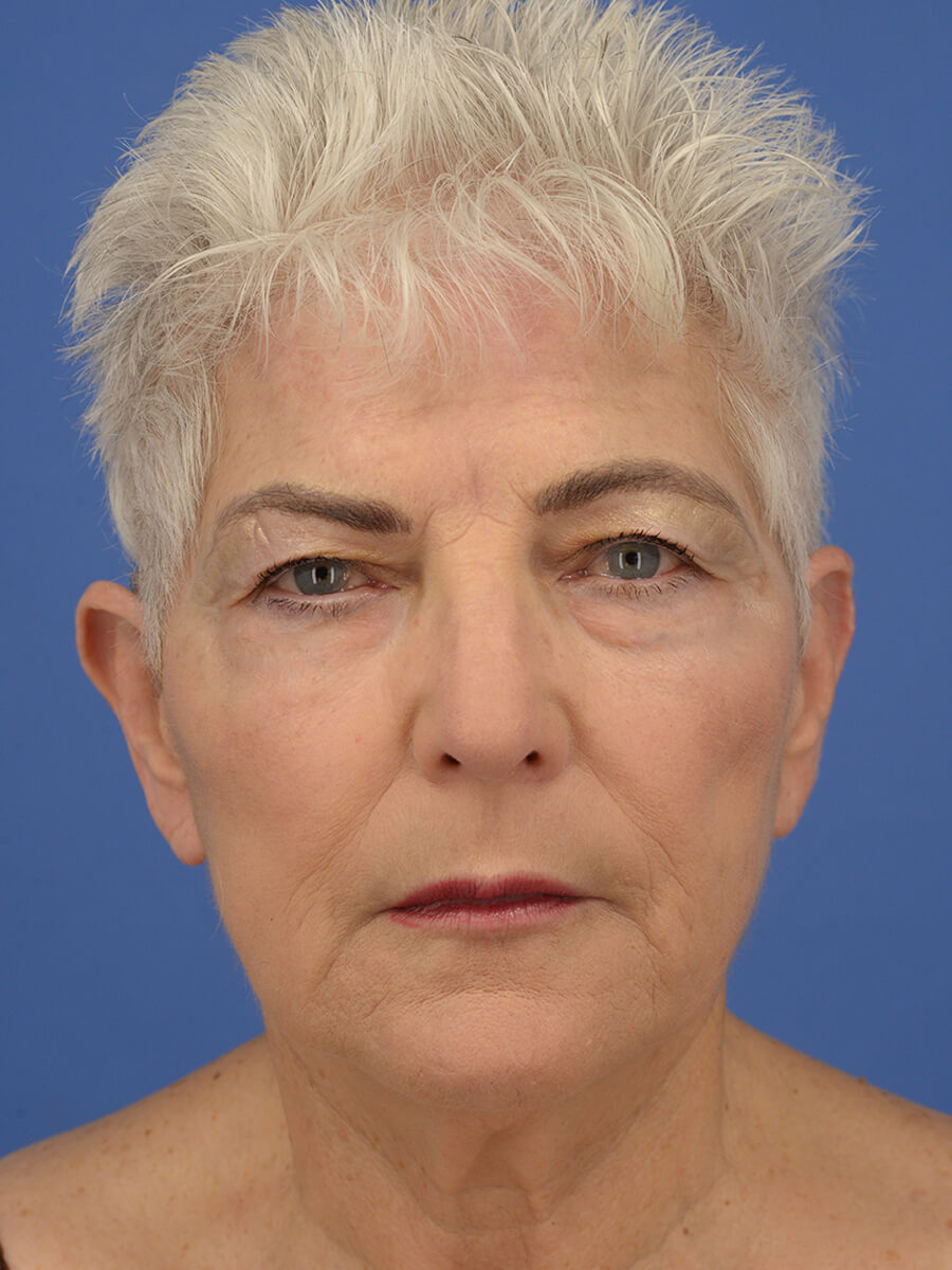 Mini Facelift | Before & After | Grass Valley, CA | Elan Clinic Plastic ...