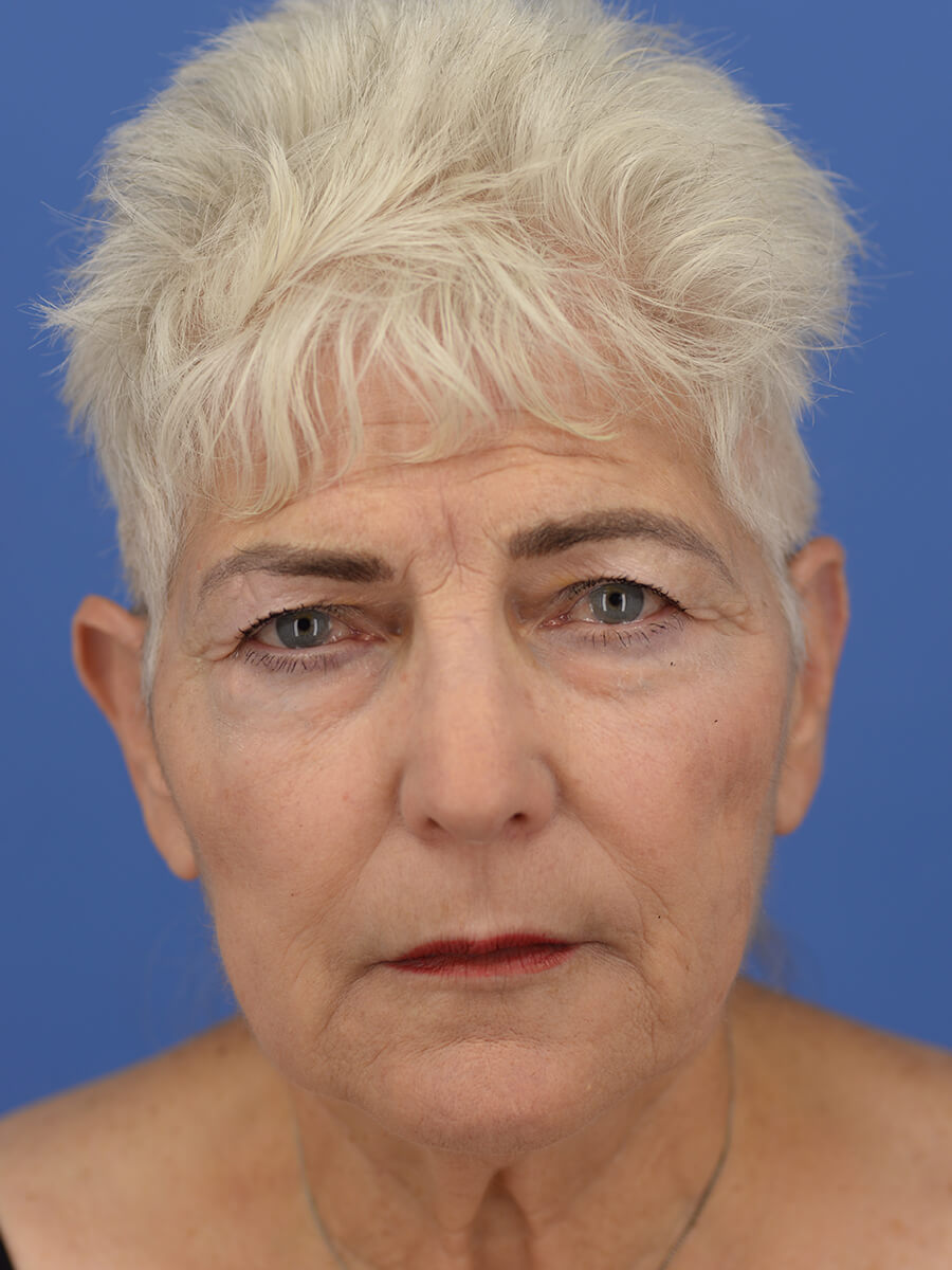 Mini Facelift | Before & After | Grass Valley, CA | Elan Clinic Plastic ...